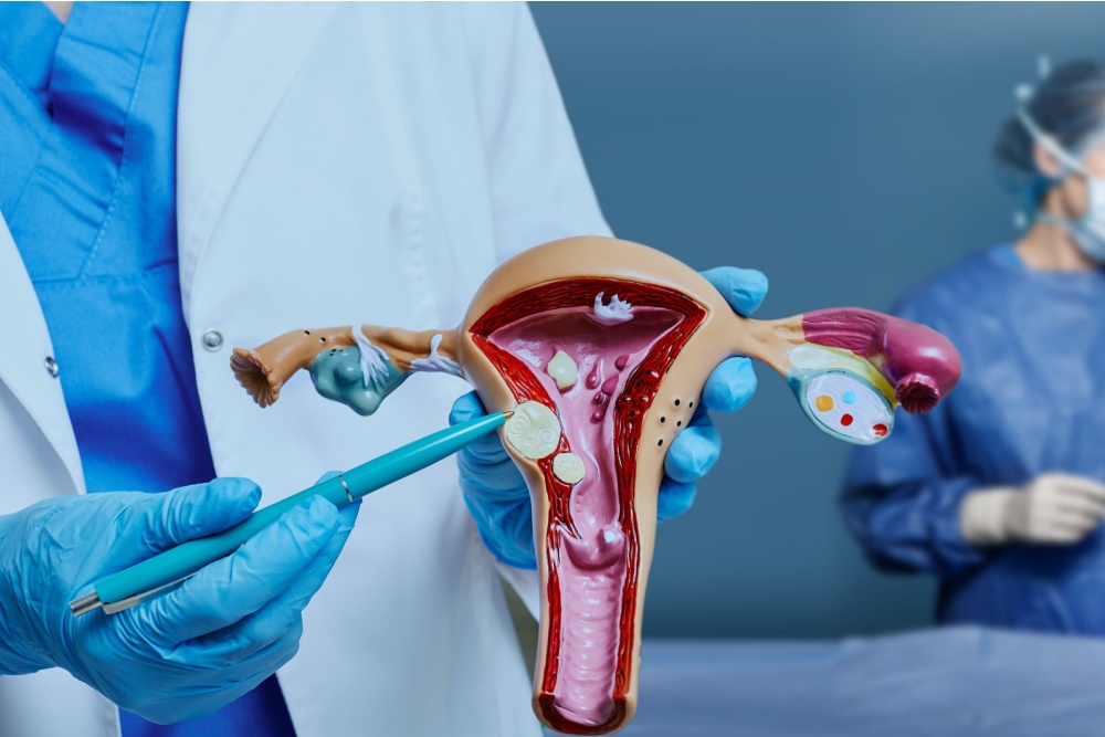 Cirurgia de miomas uterinos - Clínica Pronatus